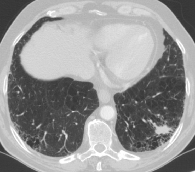 Uniportal Vats Left Posterobasal Anatomical Segmentectomy S9 10 Ctsnet